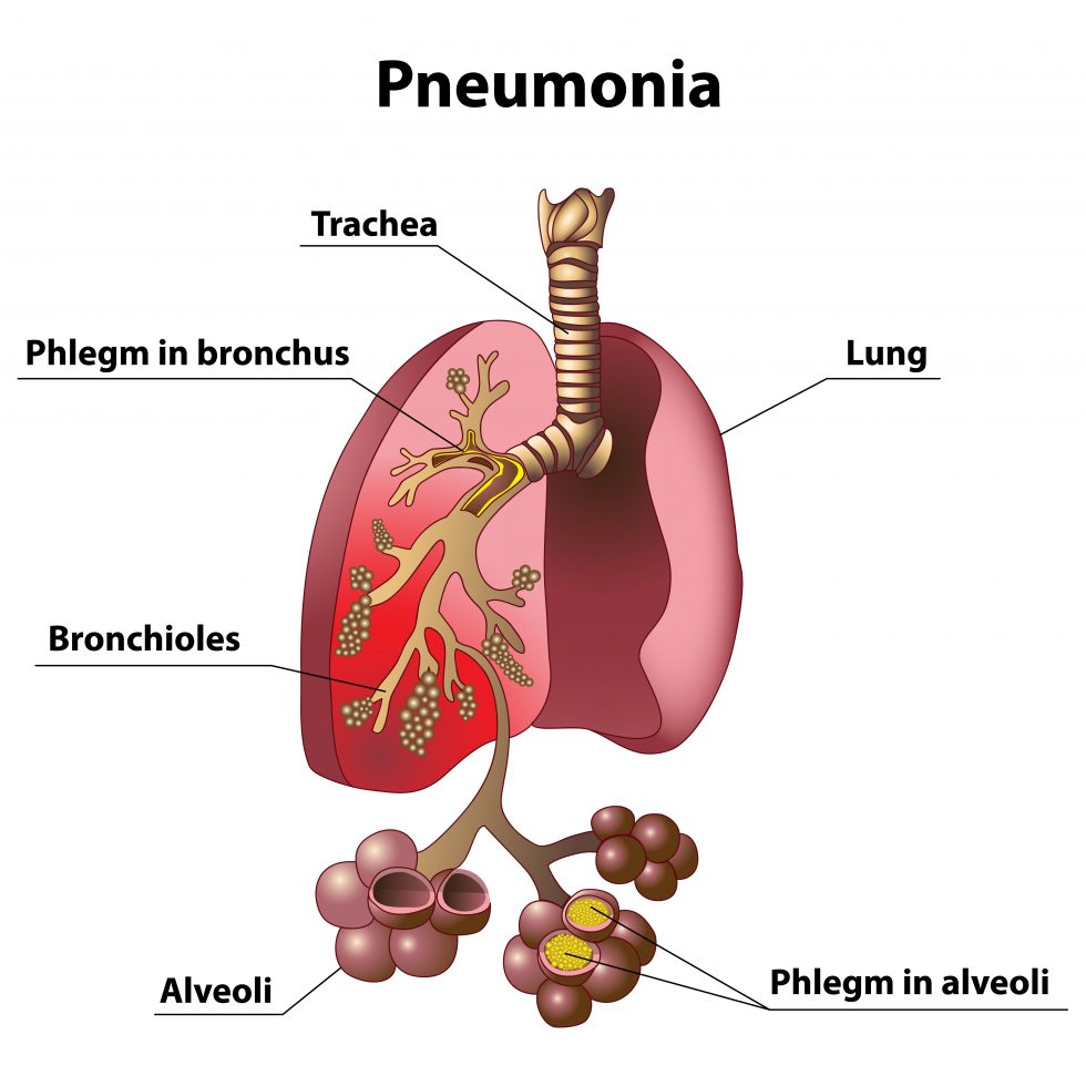 Pneumonia - JASE Medical