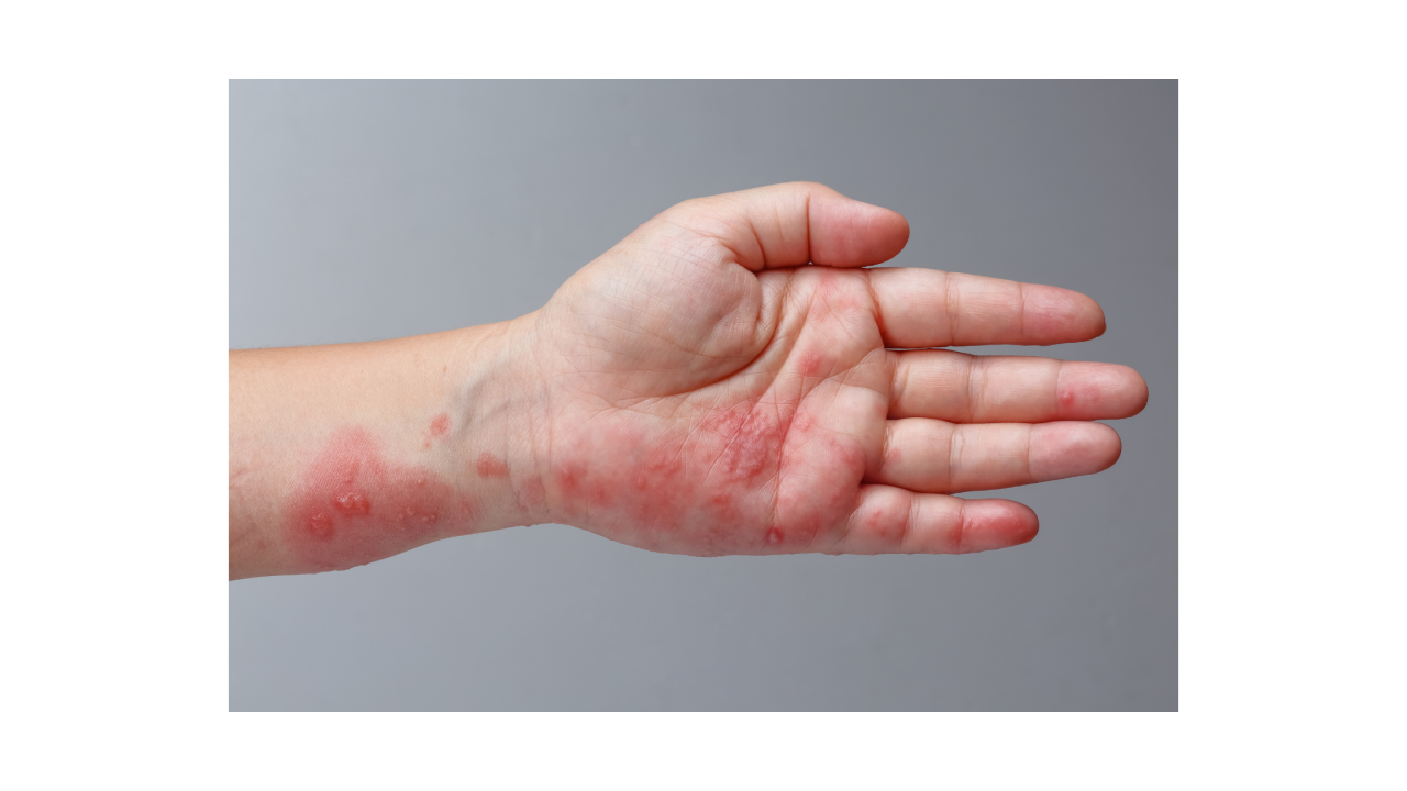Ivermectin for Scabies- and More - JASE Medical